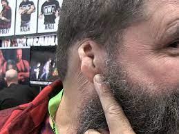 How did WWE legend Mick Foley injure his ear?