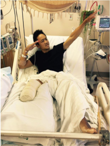 How did Albert Lin lose his leg?